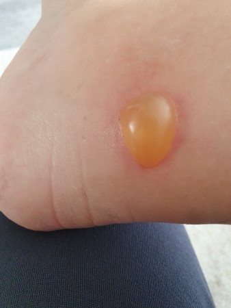 Advice on a bite - theDIBB